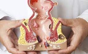 Basura ne iyi gelir? Basur acısı nasıl geçer? - Gaziantep Son Dakika ...